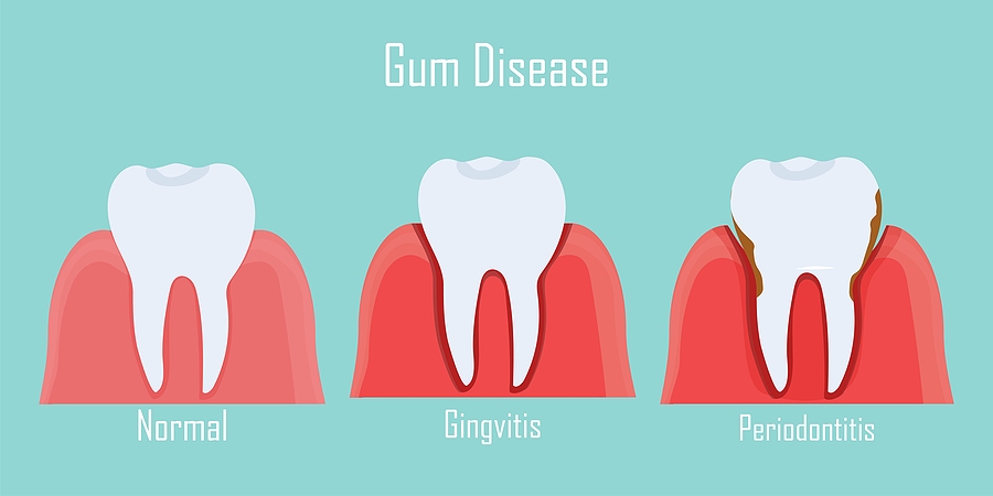 Gingival (Gum) Health & Periodontal Disease | Alpine Family Dental